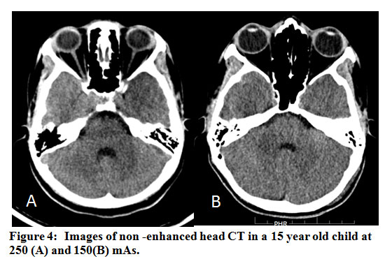 Optimization Of Pediatric CT Brain Protocol To Achieve Reduced Patient