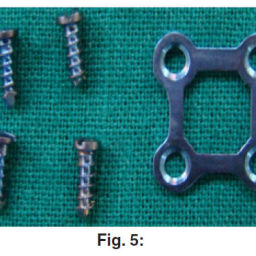 Three Dimensional Titanium Mini Plates in Management of Mandibular ...