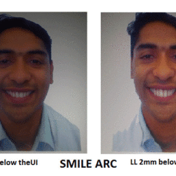 An Evaluation of the Attractiveness of A Posed Smile with Computerised ...