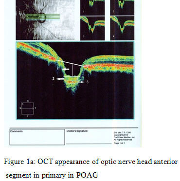 Comparison of the Prelaminar and Lamina Cribrosal Thickness in Patients ...