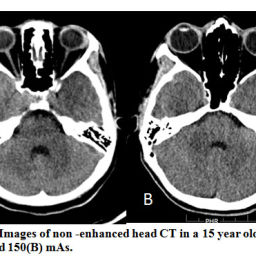 Optimization of Pediatric CT Brain Protocol to Achieve Reduced Patient ...