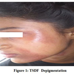 Evaluation of Adverse Drug Reactions caused by Topical Steroids in ...