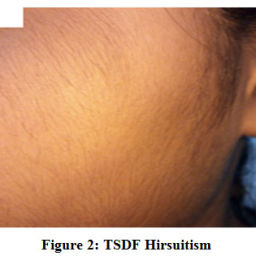 Evaluation of Adverse Drug Reactions caused by Topical Steroids in ...