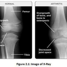 An Overview of Medical Imaging Techniques for Knee Osteoarthritis ...