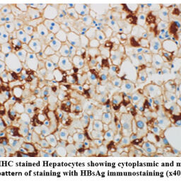 Association between the Expression Patterns of Hepatitis B Surface ...