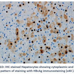 Association between the Expression Patterns of Hepatitis B Surface ...