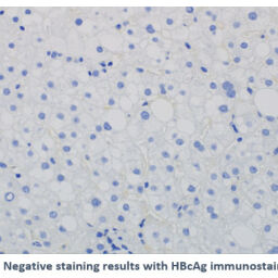 Association between the Expression Patterns of Hepatitis B Surface ...