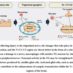 Pathophysiology, Clinical Implications and Management of Orofacial Neuropathic Pain- with ...
