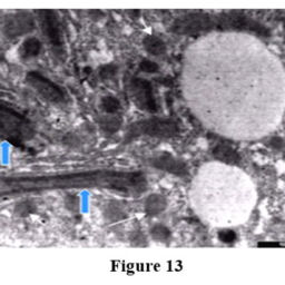 Electron Microscopic Studying the Impact of Ozone on Chronic Hepatitis ...